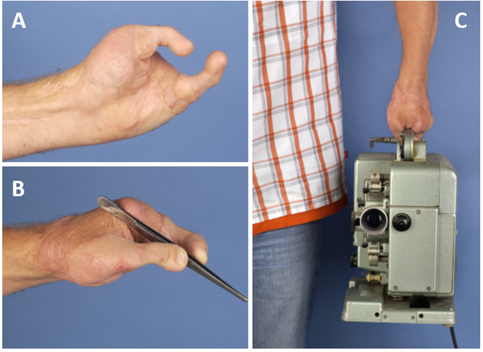 Staged Hand Salvage and Reconstruction with Three Free Tissue Transfers ...