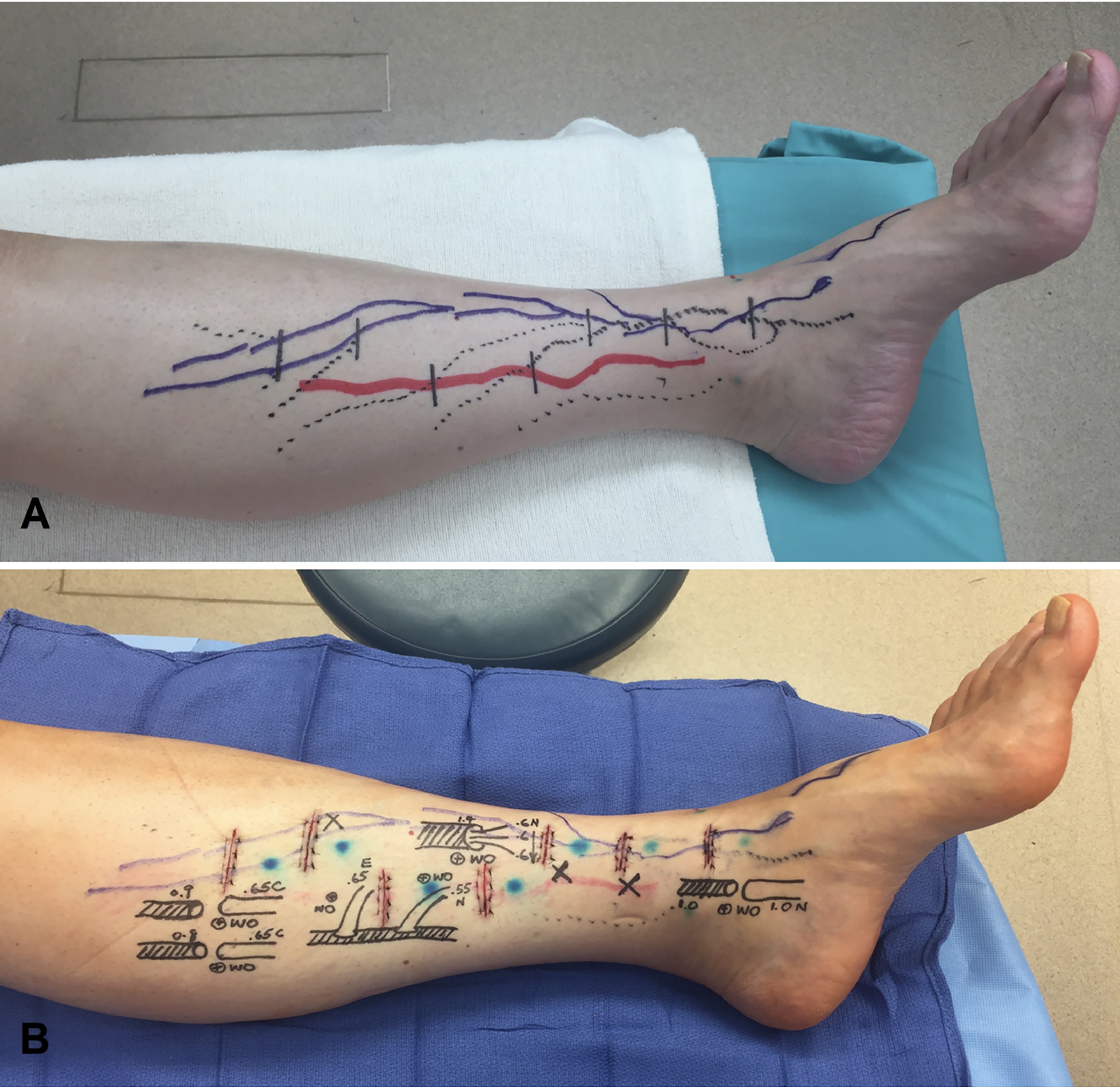 Immediate Limb Compression Following Supermicrosurgical ...