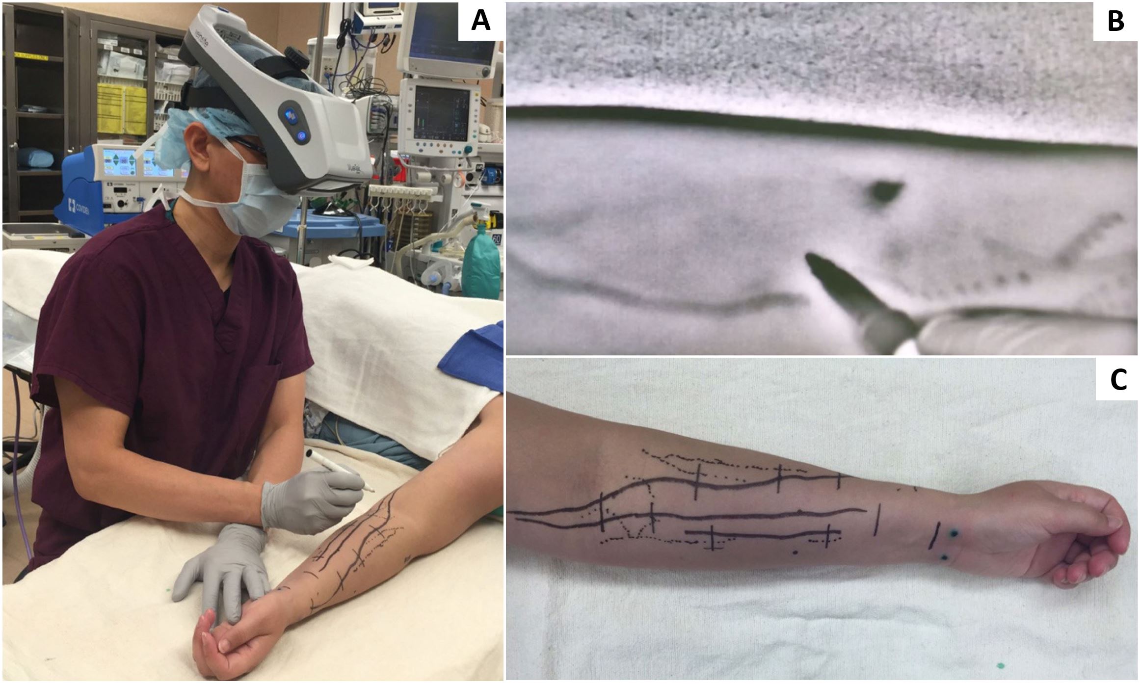 Strategic Incision Placement to Facilitate Successful ...