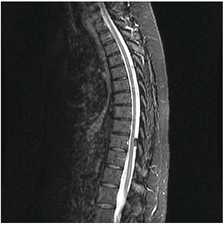 Spinal Cord Compression Due to a Catheter Tip Granuloma of an ...