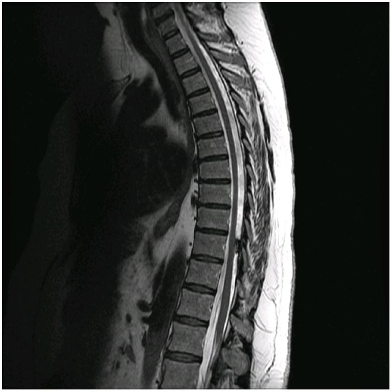 Spinal Cord Compression Due to a Catheter Tip Granuloma of an ...