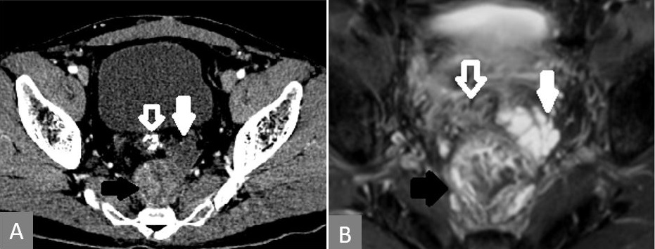 Asymptomatic Rectal Perforation After Radiation for Rectal Cancer: A ...