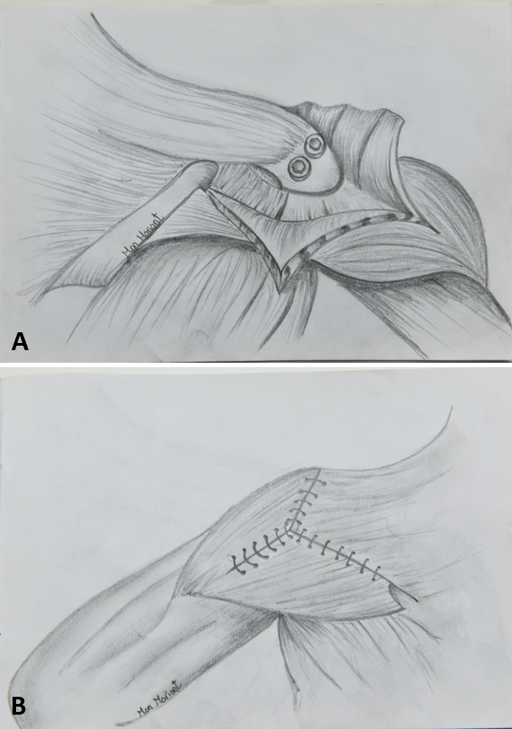 Role of Trapezius Transfer for Shoulder Reconstruction in Adult ...