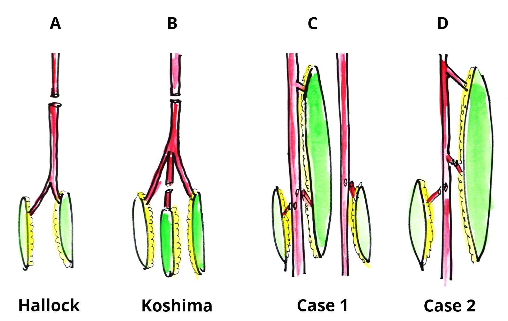 The ‘Orochi’ Flap Concept: Multi-Stage Combined Flap Using Sequential ...
