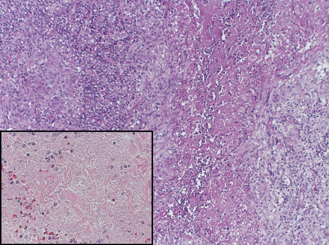 Large Non-Infectious Granulomatous Adenitis in Children Needs Surgical ...