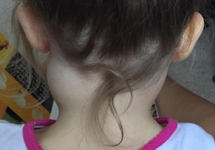Large Non-Infectious Granulomatous Adenitis in Children Needs Surgical ...