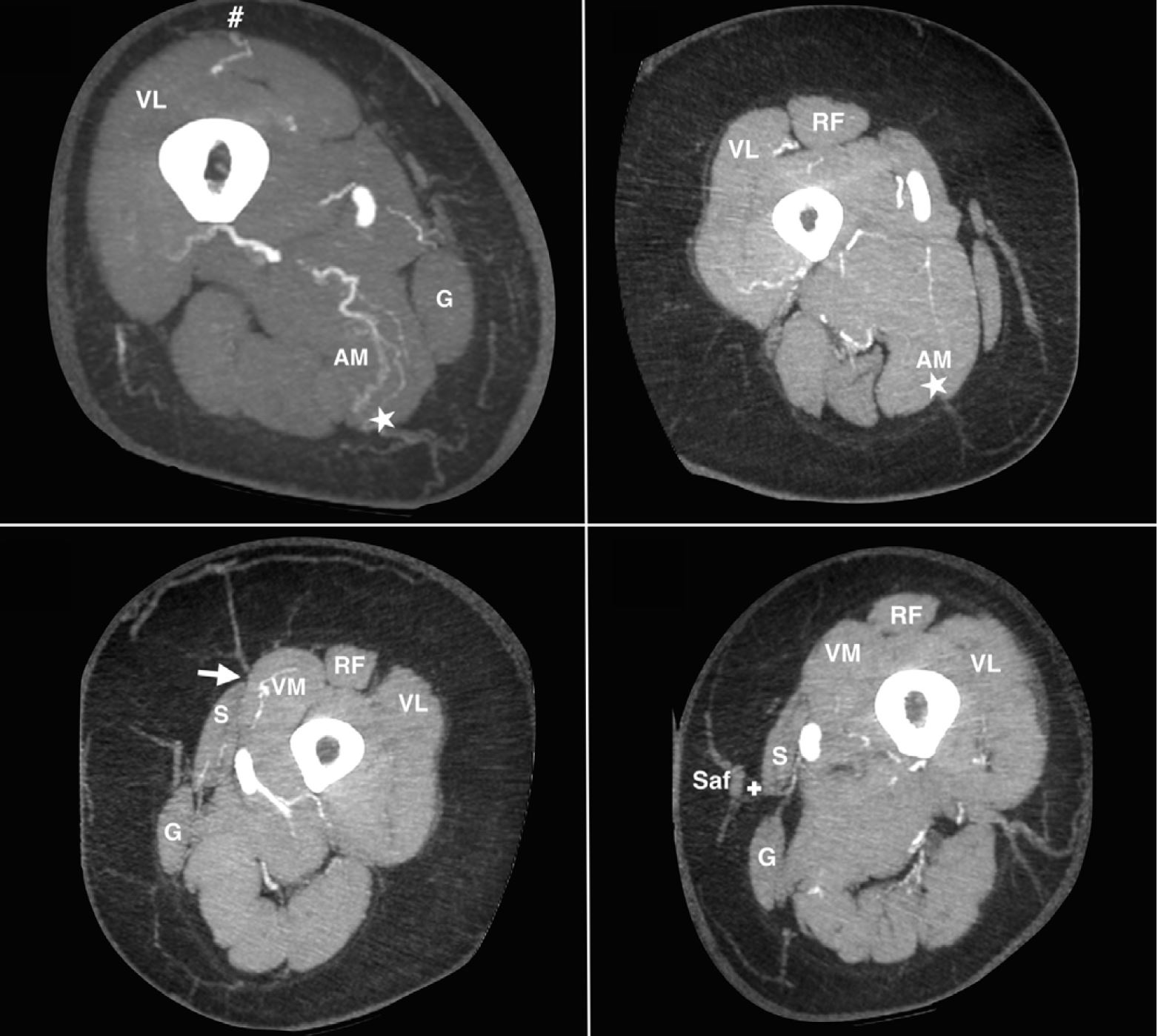 Comprehensive Analysis of Profunda Artery Perforator Flap Thickness ...