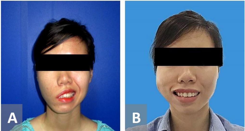 Dynamic Reanimation of Smile in Facial Paralysis With Gracilis ...