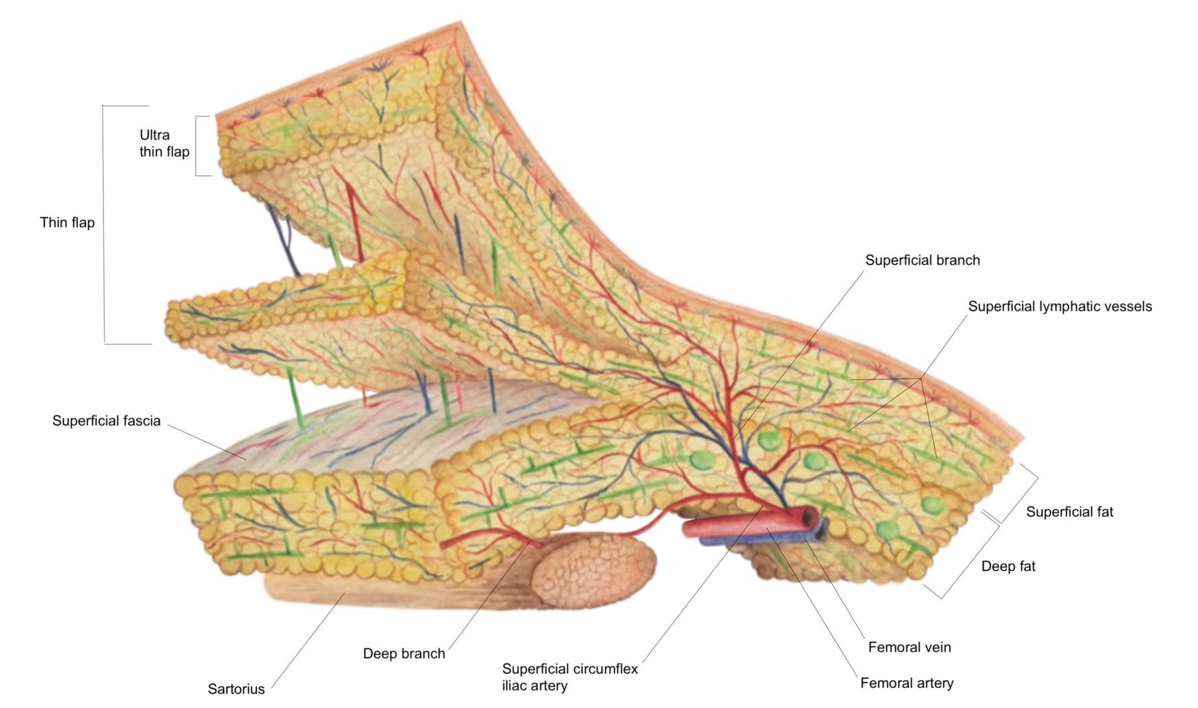 Vascularized Lymph Vessel Transfer for Extremity Lymphedema - Is ...