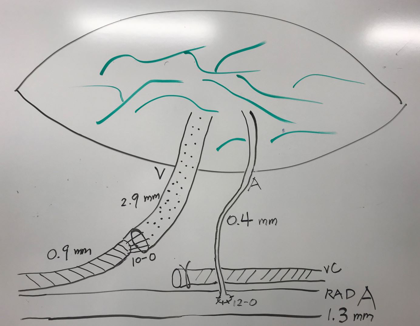 Vascularized Lymph Vessel Transfer for Extremity Lymphedema - Is ...