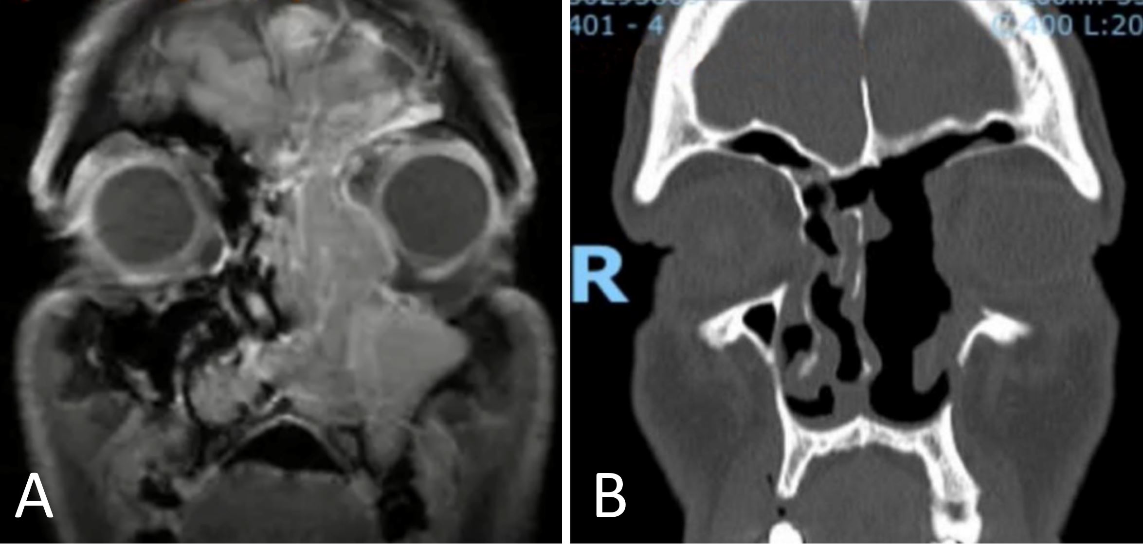 A Rare Case of High-Grade Non-intestinal Sinonasal Adenocarcinoma ...