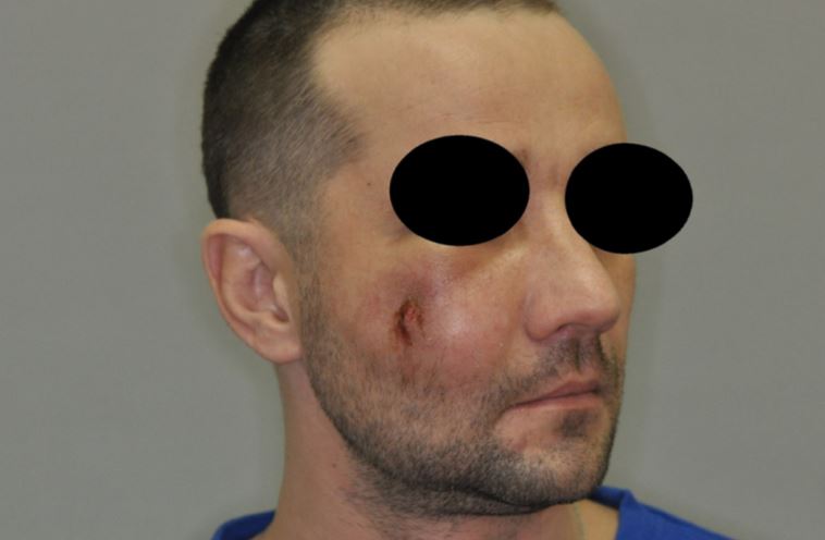 Computer-Assisted Reconstruction of the Hemimaxillectomy Defects With a ...