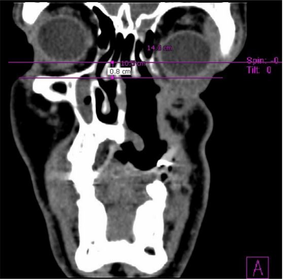 Computer-Assisted Reconstruction of the Hemimaxillectomy Defects With a ...